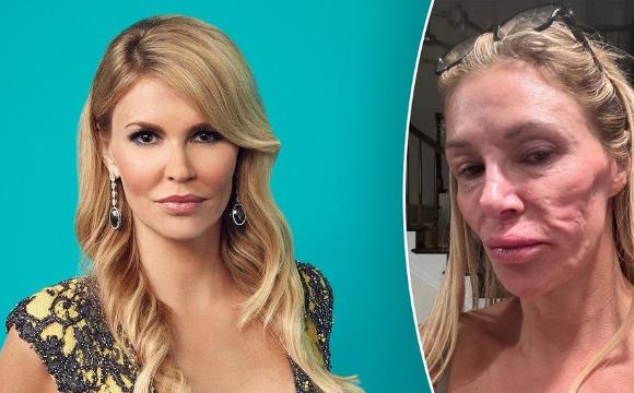 What Happens after Botox? The Tragic Story of a Former Hollywood Star ...